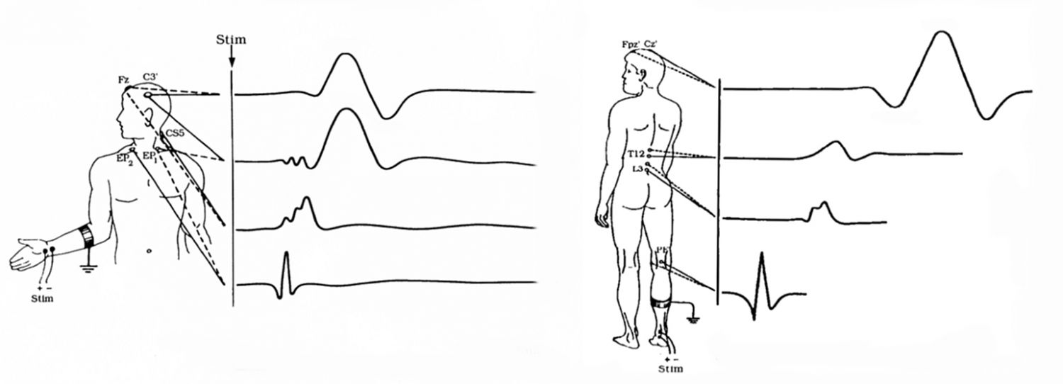 Somatosensory Evoked Potentials (SSEP) - NeurophysPedia